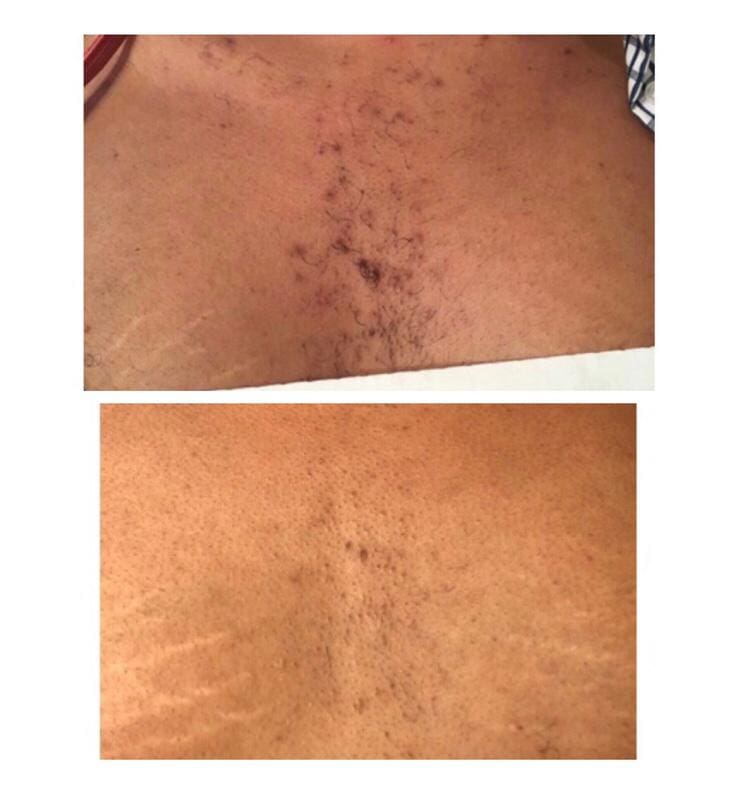 Polaris 1064 Long Pulsed ND YAG Laser hair removal System