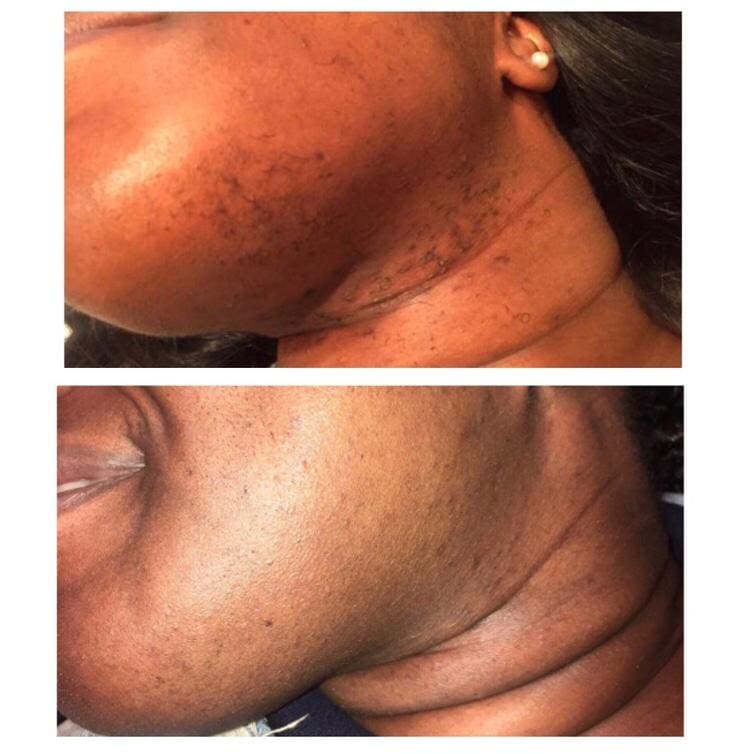 Polaris 1064 Long Pulsed ND YAG Laser hair removal System